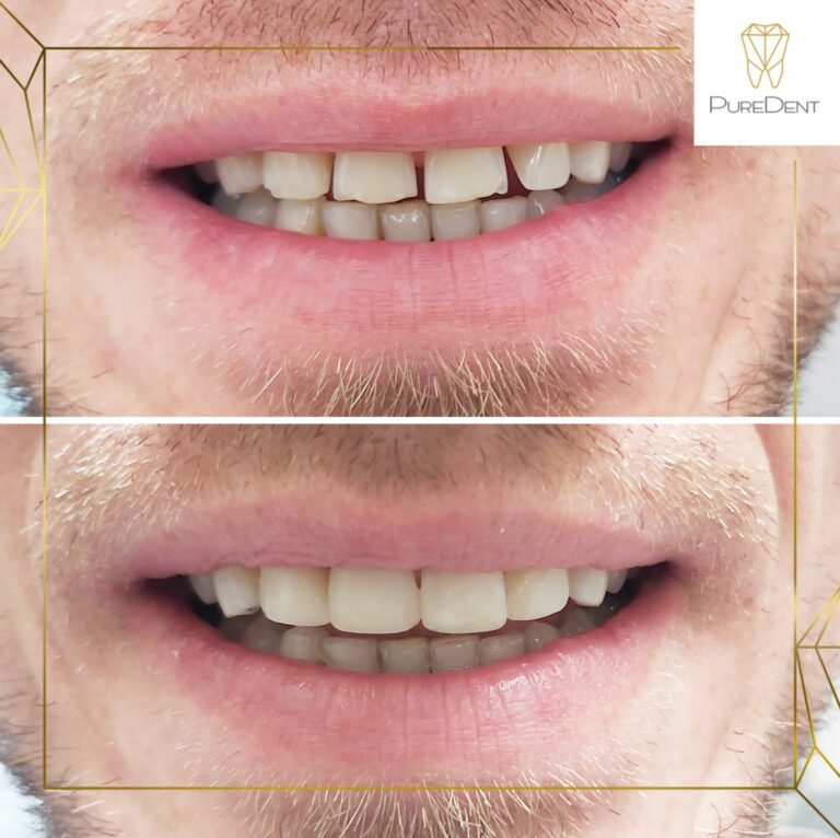 Bonding- licówki kompozytowe - Pure Dent - Stomatologia Estetyczna i ...